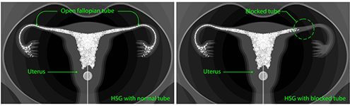 What is hysterosalpingography (HSG)? | HSG procedure | HayatMedTour